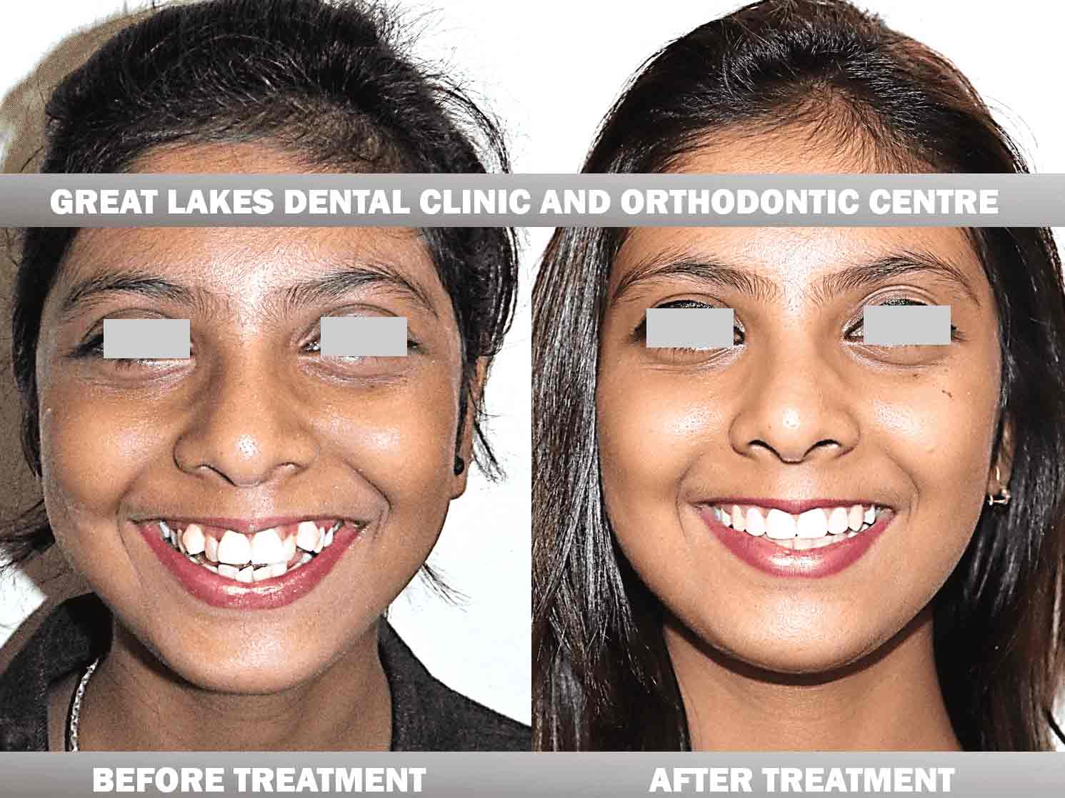Videos - Dental Braces Treatment